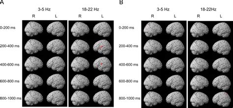Statistical Parametric Maps Of Decreased A And Increased B 35hz
