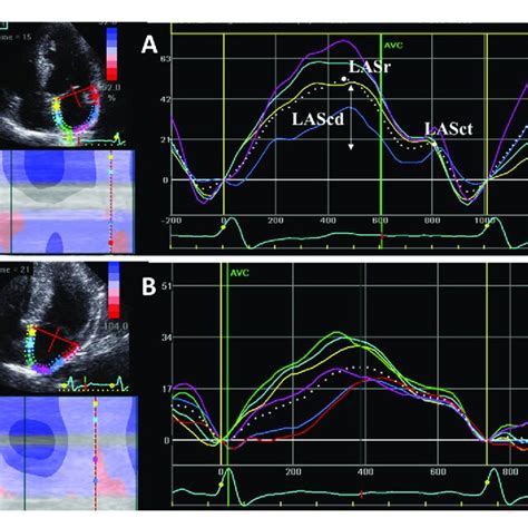 Analysis Of Left Atrial Strain In Controls A And Hypertrophic Download Scientific Diagram
