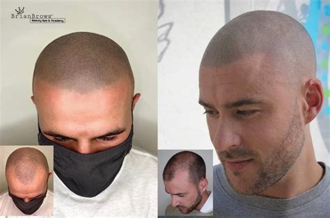 All About Scalp Pigmentation
