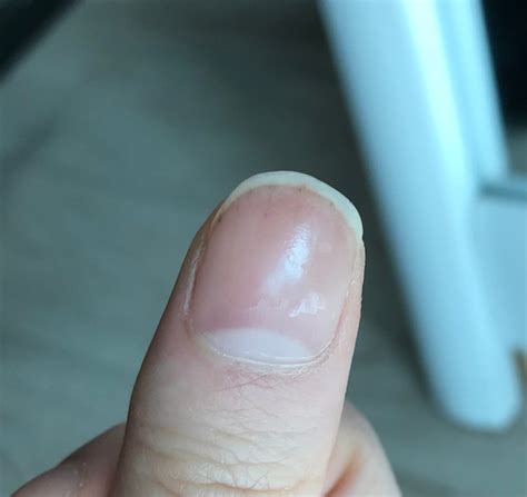 손톱 검은줄 지식in