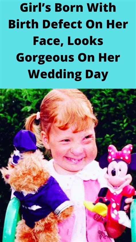 Girl S Born With Birth Defect On Her Face Looks Gorgeous On Her Wedding