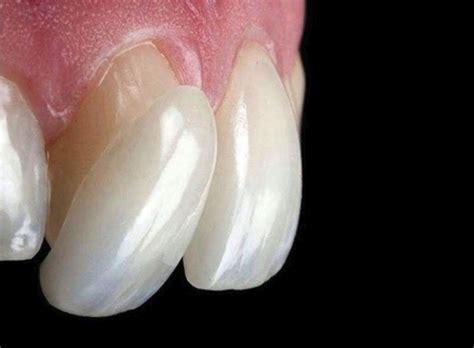 Cosmetic Veneers Dental Veneers Sydney Dental Veneers