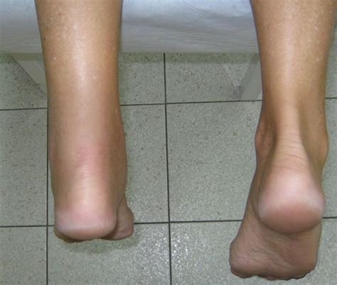 How Much Is Achilles Tendon Surgery With Insurance Livewell
