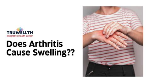 Does Arthritis Cause Swelling Utruwelllth
