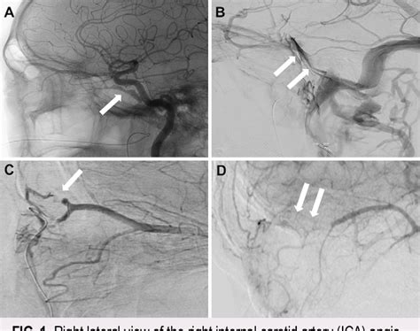 Figure 1 From A Cavernous Sinus Dural Arteriovenous Fistula Treated By