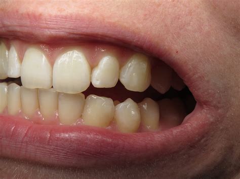 What Do Invisalign Buttons Look Like Seasons Of Smiles