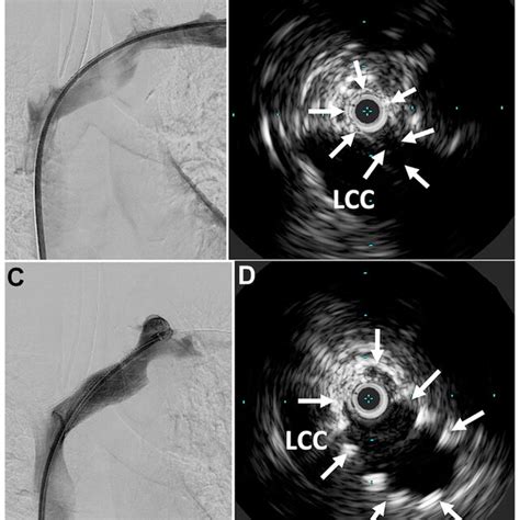 Preoperative Phlebogram A And Intravascular Ultrasound Ivus B Download Scientific Diagram