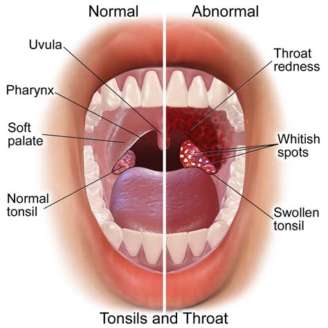 Pharyngitis Diagnosis Treatment Prevention Illnesshacker