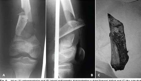 Figure 1 From Open Reduction And Internal Fixation Of Displaced