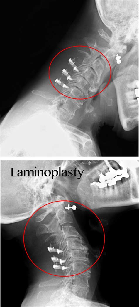 Motion Preservation Surgery Manhattan Spine Consultants