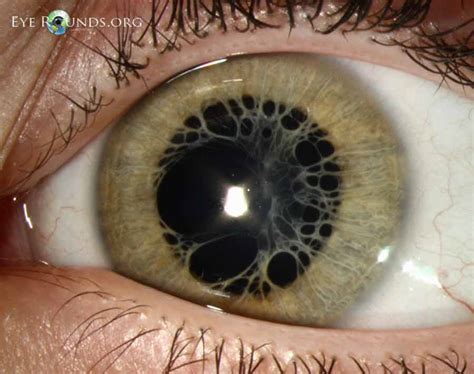 Membrane In Eye Understanding Epiretinal Membrane Causes And
