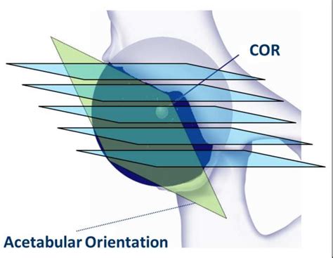 Figure 1 From High Variability Of Acetabular Offset In Primary Hip Osteoarthritis Influences