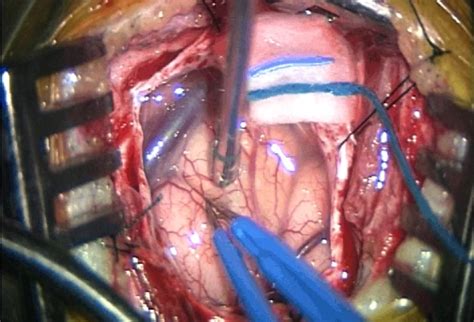 Craniotomy Macquarie Neurosurgery Spine