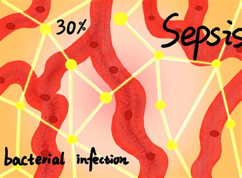 What Is Sepsis