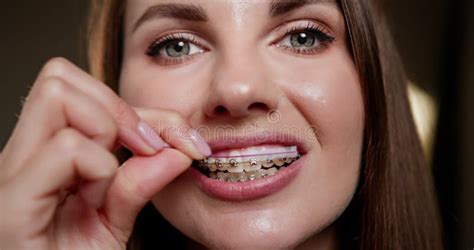 Orthodontic Care A Woman With Braces Utilizing Essential Dental