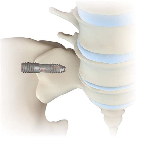 728x744 Siros Lateral Inlet 2 Genesys Spine