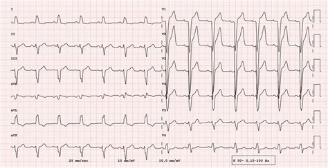 Understanding Left Bundle Branch Block Lbbb