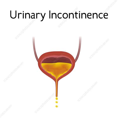 Urinary Incontinence Illustration Stock Image F0250110 Science