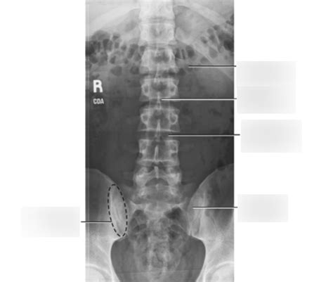 Ap Radiograph Diagram Quizlet