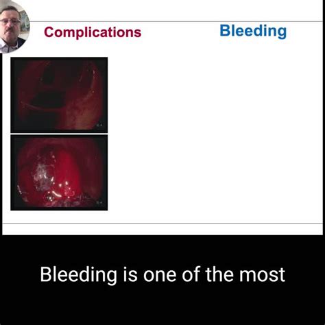 [video] Endocollab™ Gi Endoscopy Education On Linkedin Post