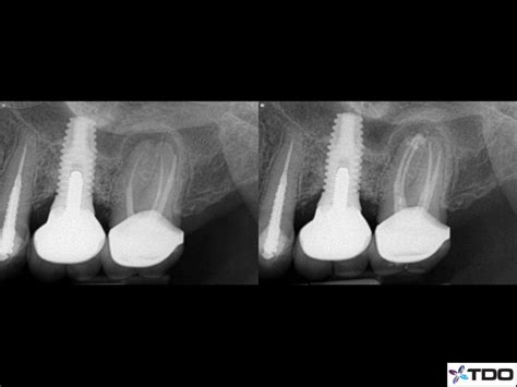 Predicting Endodontic Success