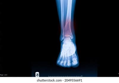 Closed Fracture Distal Tibia Right Leg 库存插图 2049556691 Shutterstock