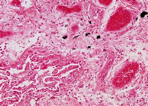 Toxoplasmosis At 10x Magnification Nikons Microscopyu