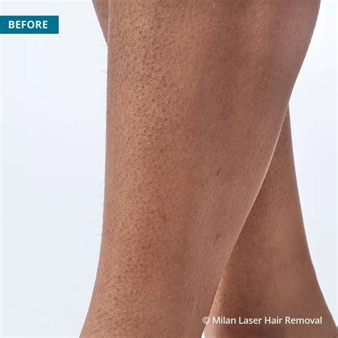Legs And Feet Before And After Photos Of Laser Hair Removal Milan Laser