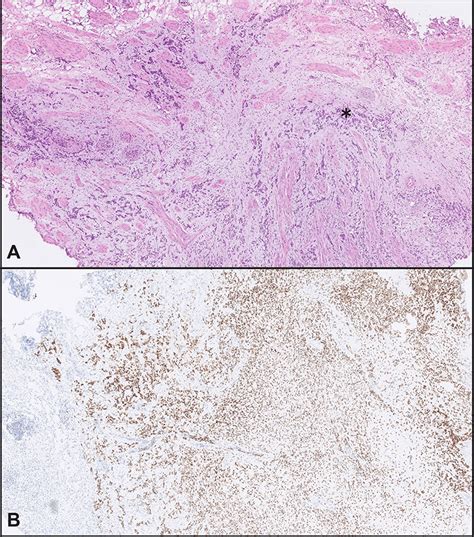 Basal Cell Carcinoma Misdiagnosed As Urothelial Cancer Rru