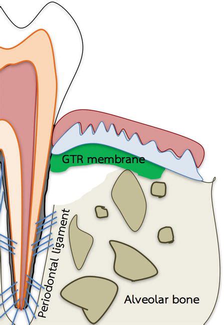 Polycaprolactone Based Biomaterials For Guided Tissue Regeneration