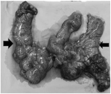 Case 1 Surgical Specimen Removed During Resection Right Colon Download Scientific Diagram