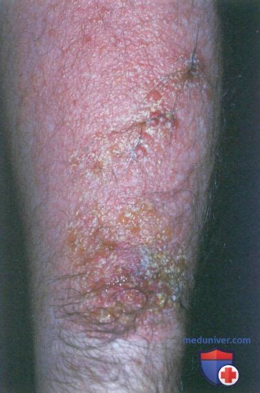 Буллезные высыпания Проявления аллергических булл