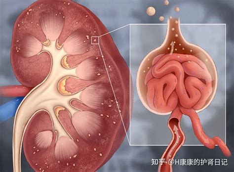 慢性肾炎是急性肾炎发展而来的吗它们两者到底是什么关系 知乎