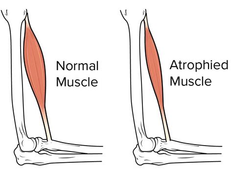Atrophy Biology Simple