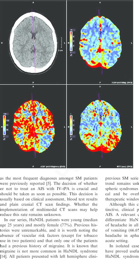 Perfusion Ct From Patient Number 7 Showing Focal Hypoperfusion In Left Download Scientific