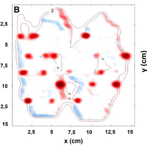 Reconstructed Dose Errors Due To MLC Leaf Position Errors Determined