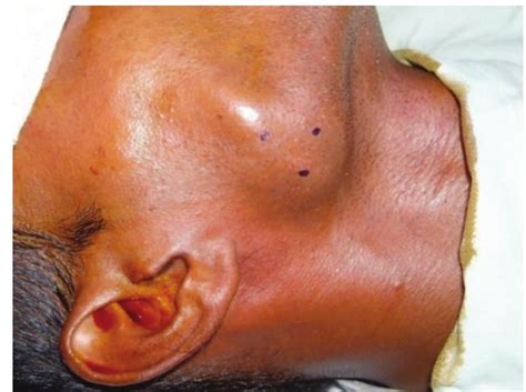 The Site Of Injection With Botulinum Toxin In Masseter