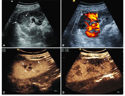 Complicated Focal Pyelonephritis With Small Abscesses 42 Year Old Download Scientific Diagram