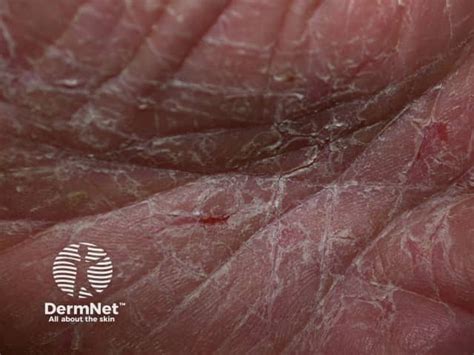 Acquired Keratoderma