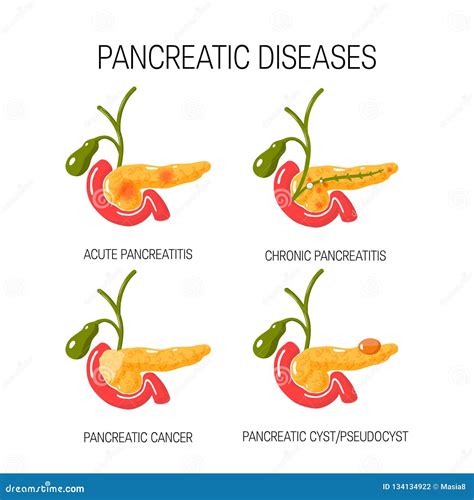 Diseases Of The Pancreas Concept Vector Illustration Stock Vector