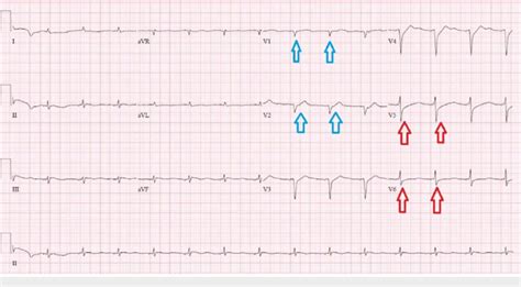 ECG Demonstrating A Sinus Rhythm At 85 Bpm With Nonspecific ST Changes