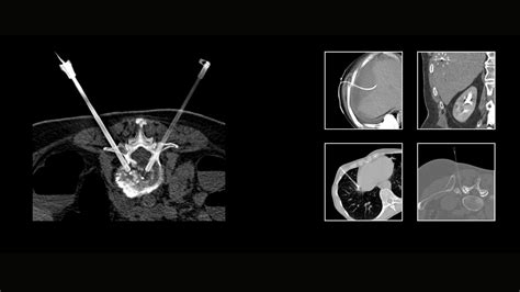 Ct Guided Interventions Siemens Healthineers Usa