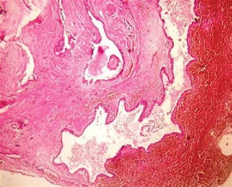 Multiple Cystic Areas With Papillary Projections Containing A Central