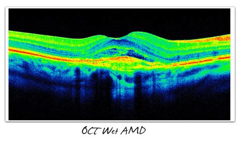 Oct Wet Amd Cure Amd Foundation