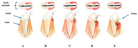 Tooth And Gum Scraping Negative Stain
