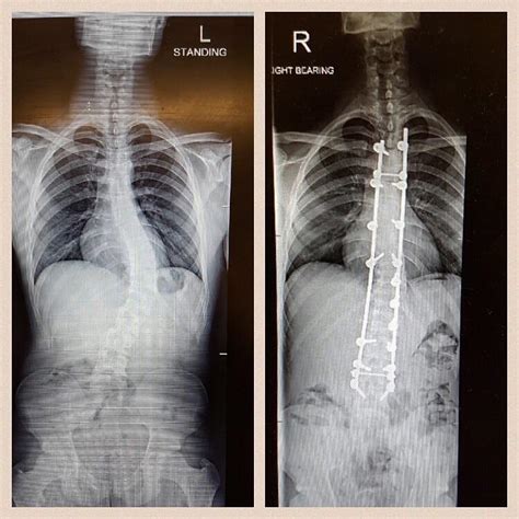 Before And After Spinal Fusion Surgery For Scoliosis Pics