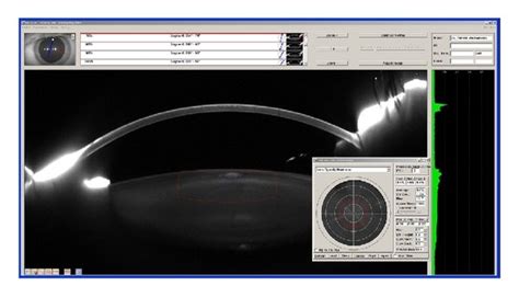 Patient Sample Of Group 3 Three Dimensional Lens Densitometry Download Scientific Diagram