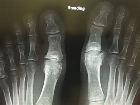 Minimally Invasive Hallux Rigidus Osteotomy David Redfern Surgery