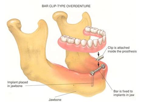 Barattachment Implant Fms Dental Hospital