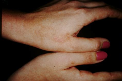 Phytophotodermatitis Treatment Pictures Photos